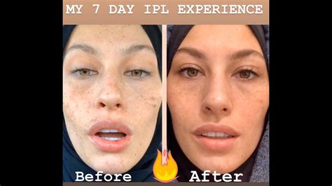 Ipl Treatment Before And After On African American