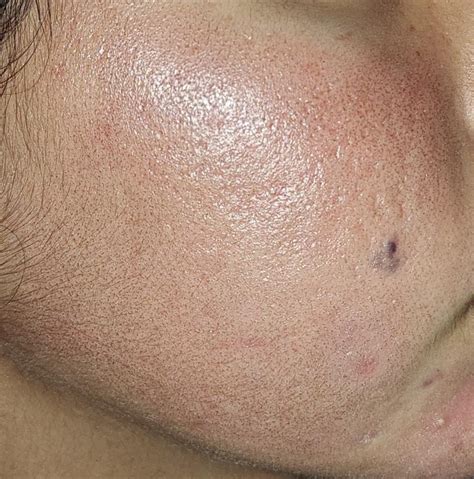 Fraxel Laser Acne Scars Racne