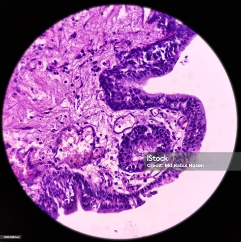 Cáncer De Próstata Adenocarcinoma Neoplasia Maligna Células Epiteliales