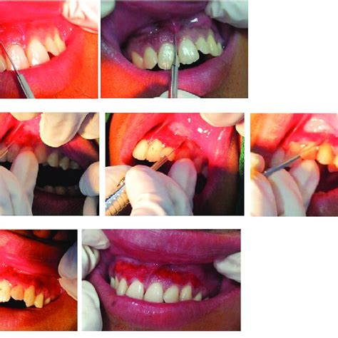 Scrapping Attached Gingival To Margin Gingival Download Scientific