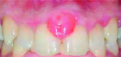 Lesion Recurrence After Six Months Download Scientific Diagram