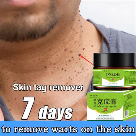 Painless Skin Tags Mole Remover Cream Genital Warts Warts Remover Corn Removal Cream G Foot