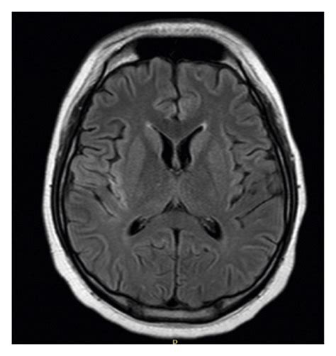 Flair Hyperintensity Over Right Temporal Lobe And Insular Region Download Scientific Diagram