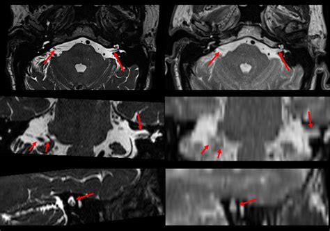 Mri Sequence Optimisation Methods To Identify Cranial Nerve Course For