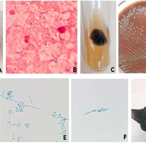 A Necrotic Deep Evolved Ulcer With Enlarged Right Axillary Lymph