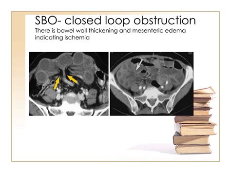 Ppt Bowel Obstruction Powerpoint Presentation Free Download Id3378275