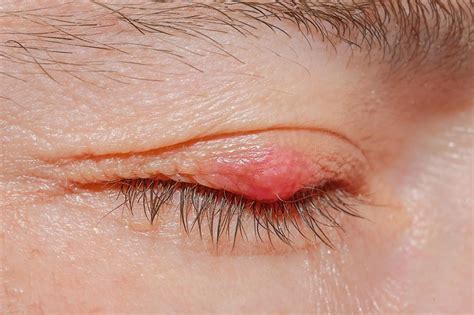 Meibomian Gland Dysfunction