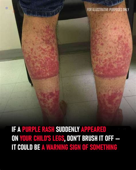 Wakeup If A Purple Rash Suddenly Appeared On Your Facebook