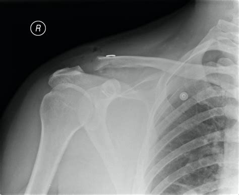 Acj Dislocation Kent Orthopaedic Practice