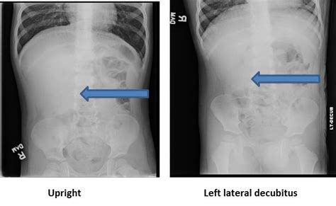 Keep Your Eye On The Target Pocus For Intussusception — Brown