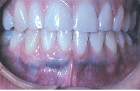 Minocycline Related Discoloration Medizzy