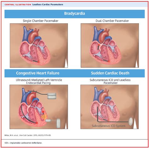 Single Chamber Pacemaker