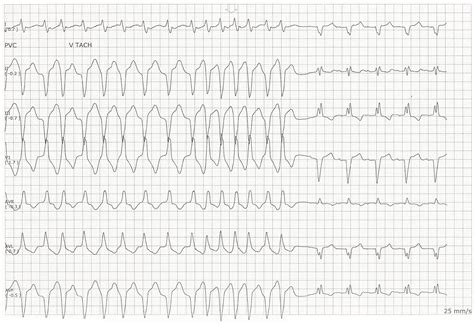 Sinus Rhythm With A Run Of Ventricular Tachycardia