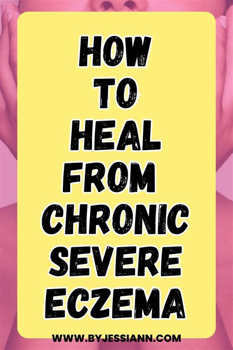 7 Eczema Remedies That Work Artofit