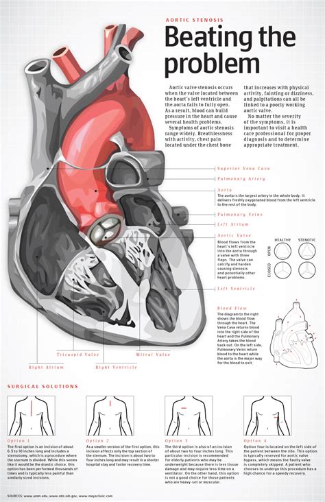 Aortic Stenosis
