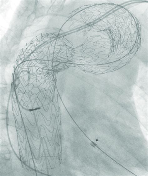Radiograph At Completion Depicting Deployed Thoracic Endovascular Download Scientific Diagram