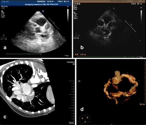 In Patient 1 Echo Showed The Thrombus Formed In The Lad And The Lumen Download Scientific