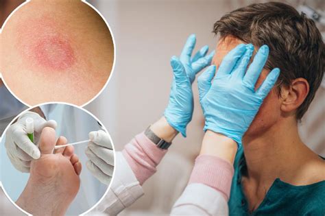New Sexually Transmitted Fungal Infection Detected In Nyc — First Us