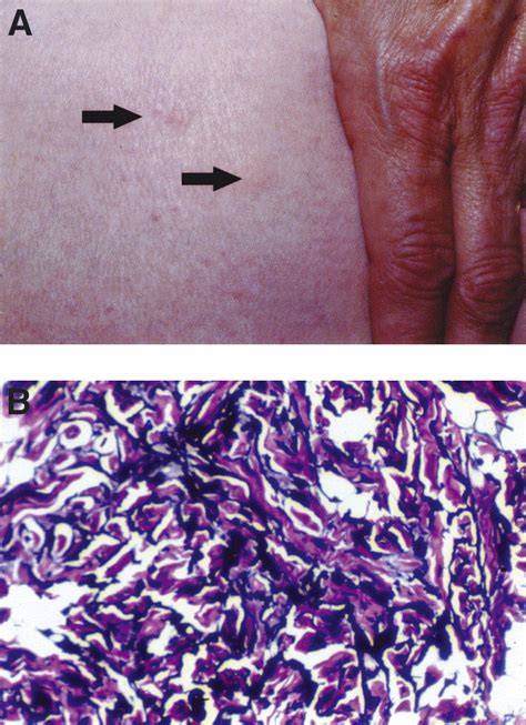 Acquired Disorders Of Elastic Tissue Part I Increased Elastic Tissue