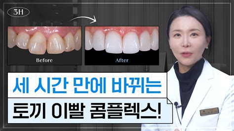 평생고민 토끼이빨 토끼치아는 3시간이면 충분히 바뀔 수 있습니다 Youtube