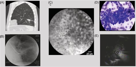 Case 3 A Sagittal Ct B Fluoroscopic Image Of Rab Needle Biopsy