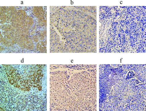 Expression Of Klf4 In Nsclc Tissues By Immunohistochemical Analysis