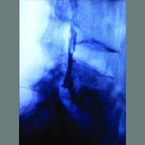Transforaminal Block Fluoroscopic Image Download Scientific Diagram