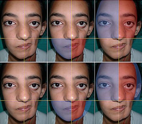 Computerized Photogrammetric Facial Symmetry Analysis With Anatomical Download Scientific