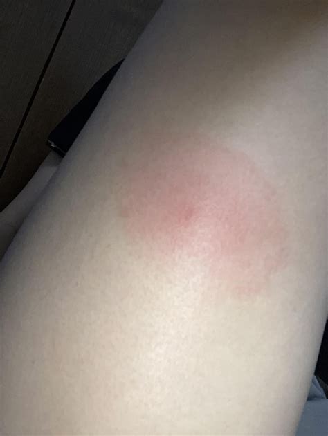 Does This Look Like Lyme Rash R Lyme