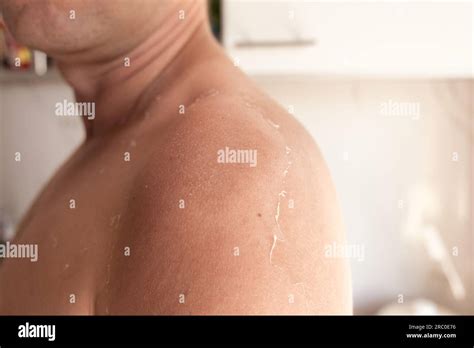 Sunburn On The Skin Exfoliation Of The Skin After Sunburn Man With