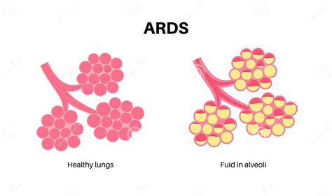 Ards Anatomical Poster Stock Vector Illustration Of Syndrome 275372099