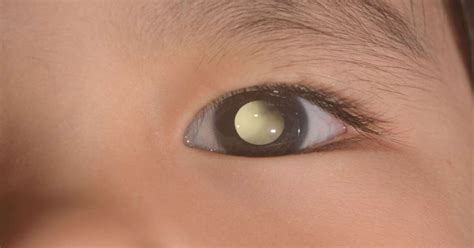 Retinoblastoma Doença Não Tem Prevenção Mas Tem Cura Entenda