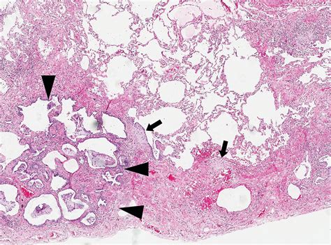 Imaging Of Pulmonary Fibrosis An Update From The Ajr Special Series