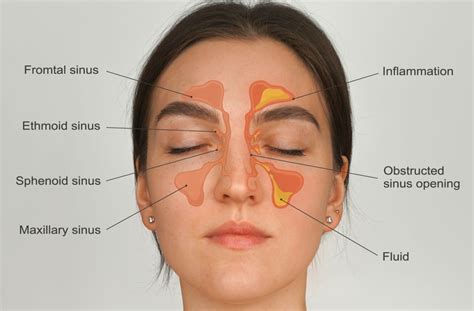 Can Sinus Pressure Cause Blurry Vision La Quinta Ca