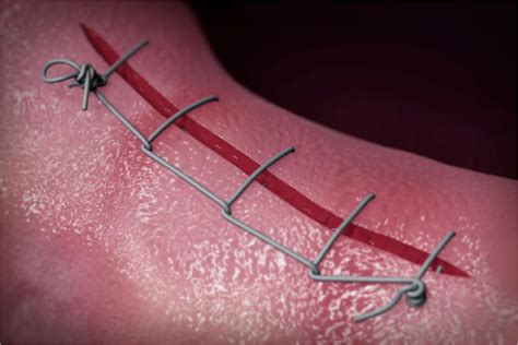 14 Continuous Lock Suture Quintessenz Verlags Gmbh