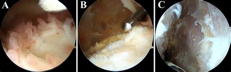 Extensive Hyperplasia Of Hemosiderin Rich Villous Synovium Can Be Seen