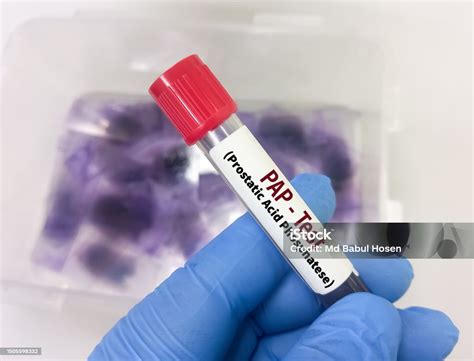 전립선암 진단을 위한 실험실 배경에서 전립선산 포스파타제 검사를 위한 혈액 샘플 개념에 대한 스톡 사진 및 기타 이미지 개념