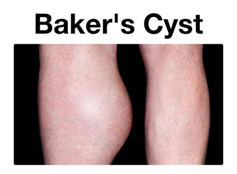 Ruptured Bakers Cyst Emmett Technique Cairns Muscular Release Therapy Australian Made