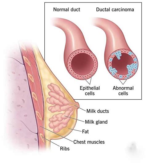 Carcinoma Treatment Aastha Oncology Associates