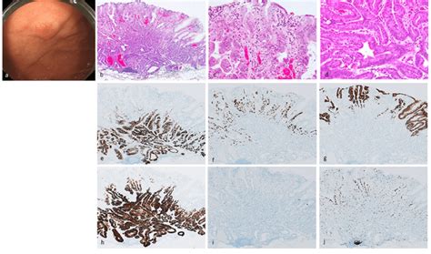 Gastric Adenocarcinoma Of Fundic Gland Mucosa Type Type 1 Organized
