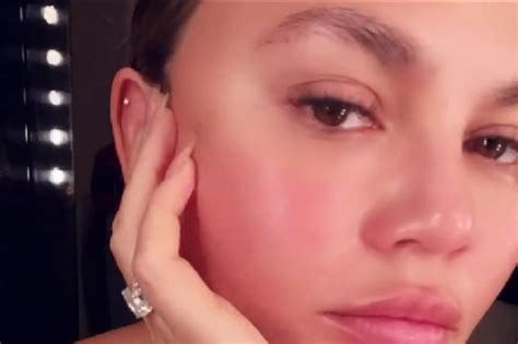 Chrissy Teigen Shares Eyebrow Transplant Progress