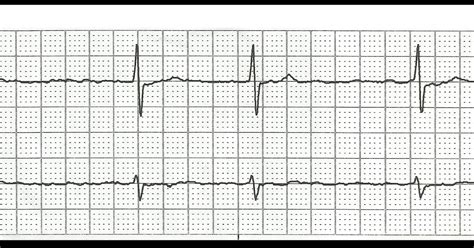 Float Nurse Ecg Rhythm Strip Quiz 114