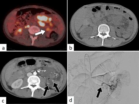 Gastrointestinal Bleeding Treated With Endovascular Embolization Axial