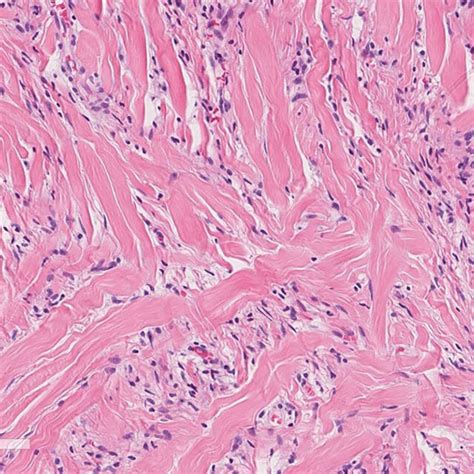 Hande Stain Of Right Heart Ventricular Mass Showing A Bland Fibroblasts