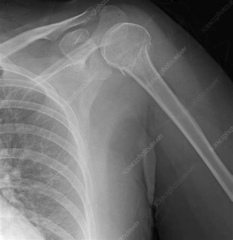 Humerus Fracture X Ray Stock Image F036 0236 Science Photo Library