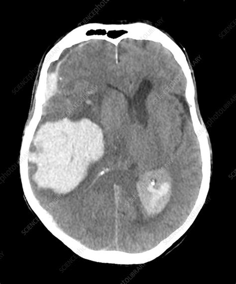 Massive Intracranial Hemorrhage Ct Scan Stock Image C0271775