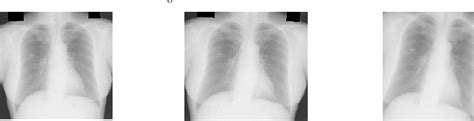 Figure 2 From Lung Field Segmentation In Chest X Ray Images Using Superpixel Resizing And