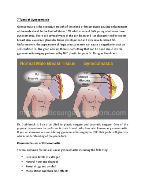 7 Types Of Gynecomastia Pdf Surgery Breast