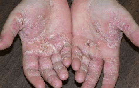 Как вылечить экзему в домашних условиях Травник