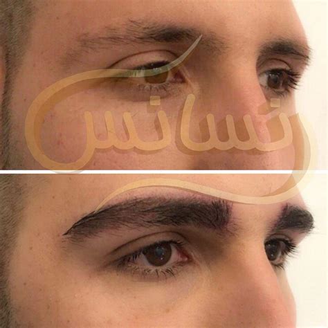 گالری کاشت ابروsut